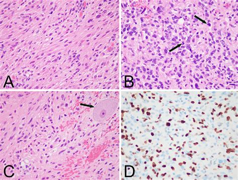 Microscopic Pathology Of The Spinal Cord Neoplasm A Hematoxylin And