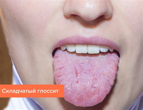 Diseases Of The Tongue Symptoms And Descriptions Of Diseases Of The