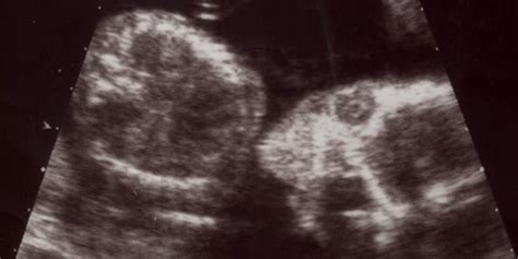 Op Ed Argues For The Right To Abort Fetus With Down Syndrome Fox News