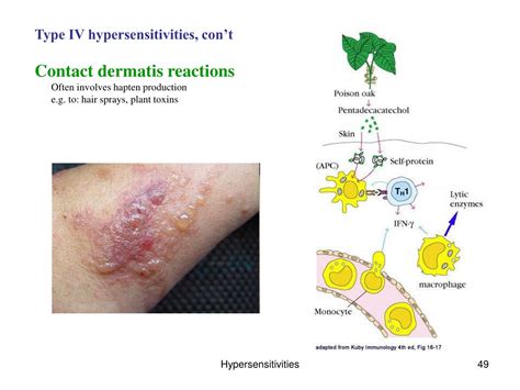 Ppt Hypersensitivity And Autoimmunity Powerpoint Presentation Free