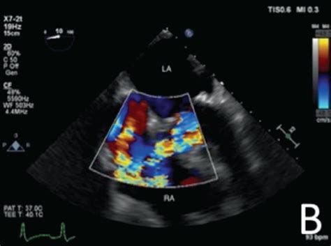 Tee Demonstrates Mobile Echodensity Red Arrow Measuring 24 Cm×19 Cm