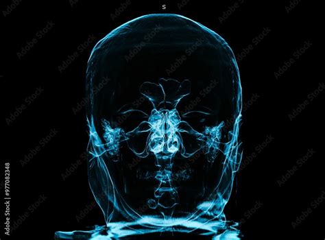 Photo Stock Upper Airway Ct Scan 3d Head Ct Scan Coloured 3d Computed