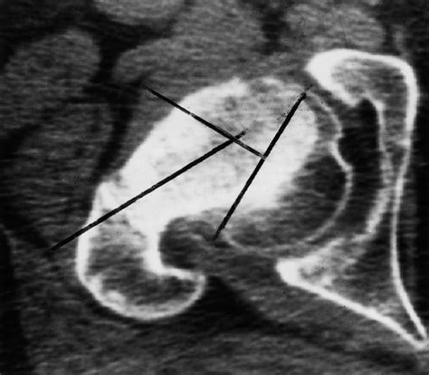 Slipped Capital Femoral Epiphysis Clinical Tree