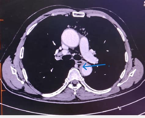 Ct Angiogram Study Of The Aorta Shows An Asymmetric Circumferential