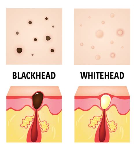 Understanding Blackheads And Whiteheads Causes Differences And Simi