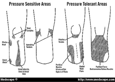 Amputation Pre Prosthetic Evaluation And Interventions Flashcards Quizlet
