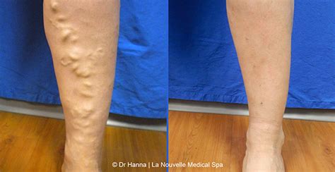 Before And After Photos Of Varicose And Spider Vein Removal By Dr
