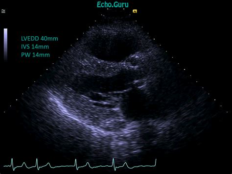 Are Thick Lv Walls The Same As Lv Hypertrophy Echoguru