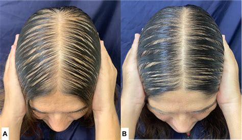 Bicalutamide 25 Mg Combined With Minoxidil 1 Mg Versus Minoxidil 1 Mg