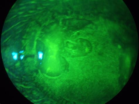 Lasik Flap Dislocation The Flap Never Heals