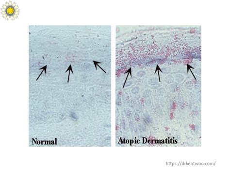 The Heartbreak Of Eczema Understanding Infections In Eczema