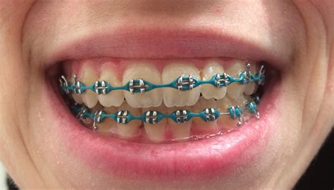 Jenis Braces Power Chain At Mai Lowder Blog