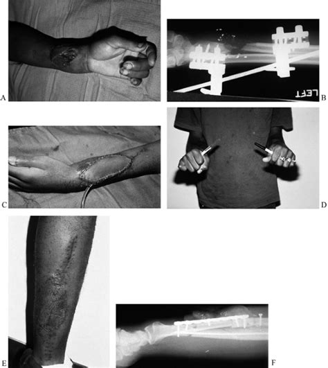 Tissue Transfer At Elma Thomas Blog