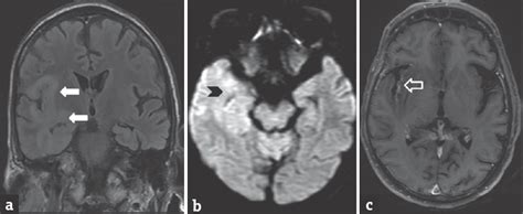 Magnetic Resonance Imaging Findings In Viral Encephalitis A Pictorial