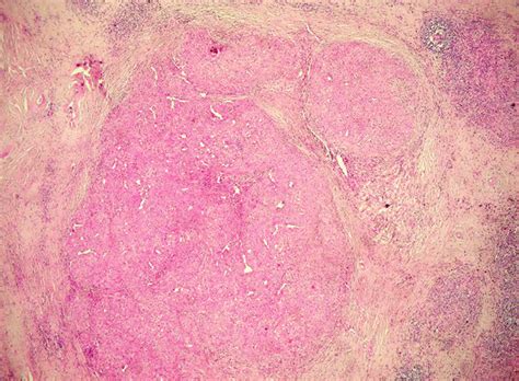 Low Power Photomicrograph Showing Variable Sized Nodules Hande 40×
