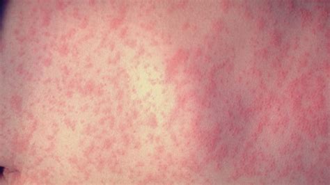 Colorado Health Officials Check Measles Vaccine Status Ahead Of Spring