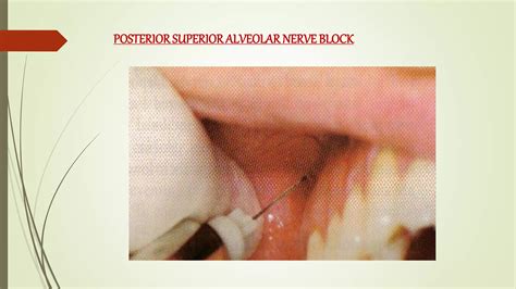 Superior Alveolar Nerve Blockpptx
