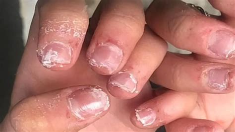 How To Treat An Allergic Reaction To Gel Nail Polish Explain