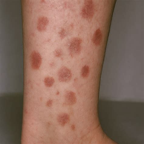 Diabetic Skin Conditions Visual Guide And Pictures