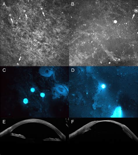 In Vivo Confocal Microscopy Displaying Double Walled Acanthamoeba Cysts