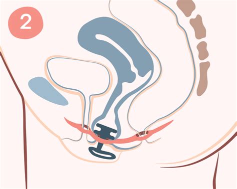 Efemia Bladder Support Efemia