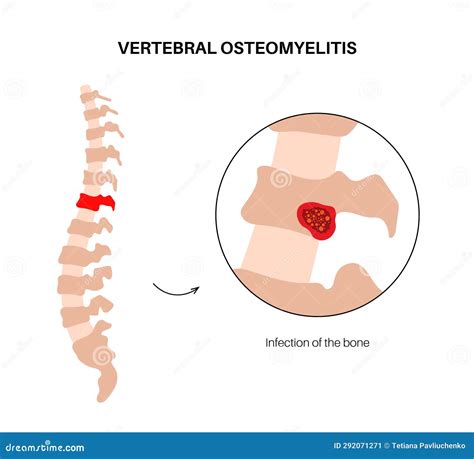 Vertebral Osteomyelitis Poster Cartoon Vector 292302781