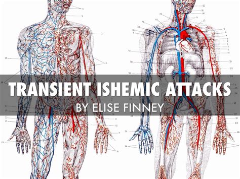 Transient Ischemic Attacks By Elise Finney