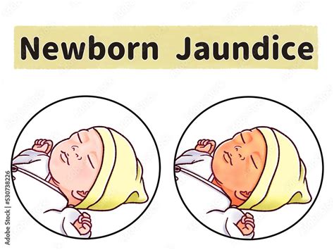 新生児黄疸（病的黄疸）のイラスト素材 英語 Stock Illustration Adobe Stock