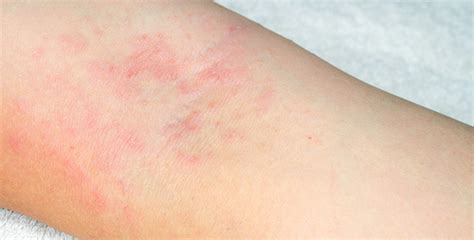 Infección Por Levaduras En La Piel Candida Albicans Wikipedia La