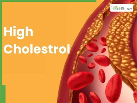 High Cholesterol Symptoms 5 Warning Signs You May Notice In Your Hands