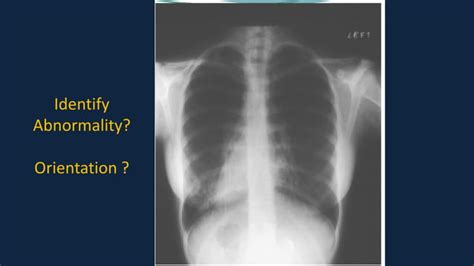 Pediatric Chest X Ray Interpretation Pdf