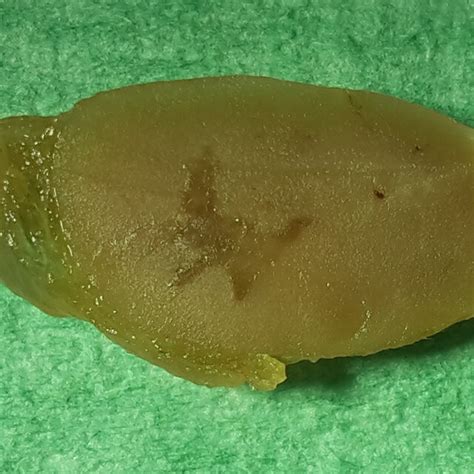 Cross Section Of The Formalin Fixed Left Thyroid Gland Of A 27 Year Old