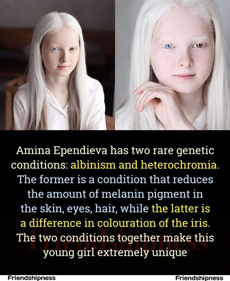 The Amina Ependieva Has Two Rare Genetic Conditions Albinism And