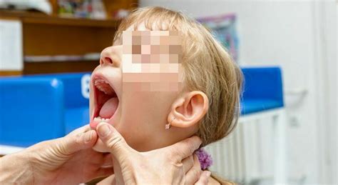 Streptococco Sintomi Tamponi E Terapia Con Antibiotici Cosa Fare Boom Di Contagi Soprattutto