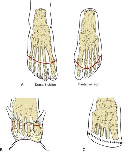 Amputation Causes Types Of Amputation And Amputation Complications