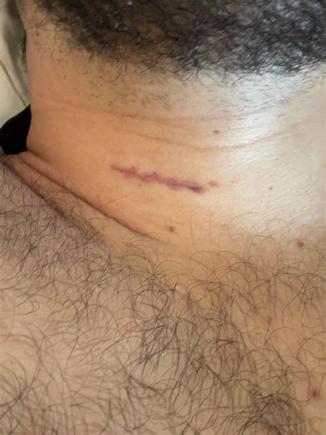 Success Story C5 C7 Mobi C Disc Replacement Rspinesurgery