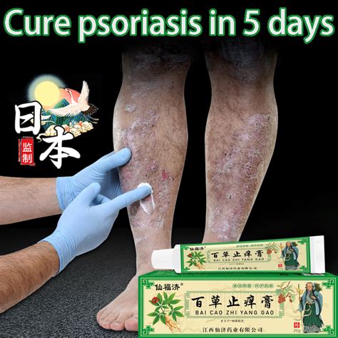 Psoriasis Cream Dermatitis Eczematoid Eczema Ointment 20g Krim Rawatan Eczema Dan Psoriasis