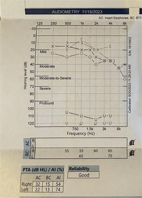 Can Someone Decode This Chart For Me Wondering If Hearing Aids Would