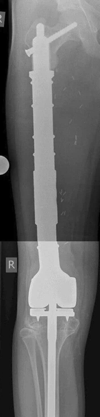 Non Cemented Custom Made Short Stem Megaprosthesis With Cross Pins