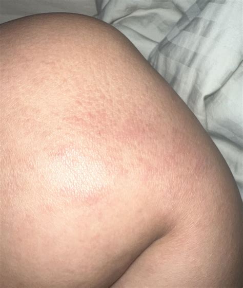 Lichen Simplex Chronicus R Eczema