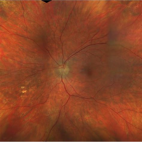 Visual Field Exam 302 Visual Field Exam Revealed Peripheral Defects