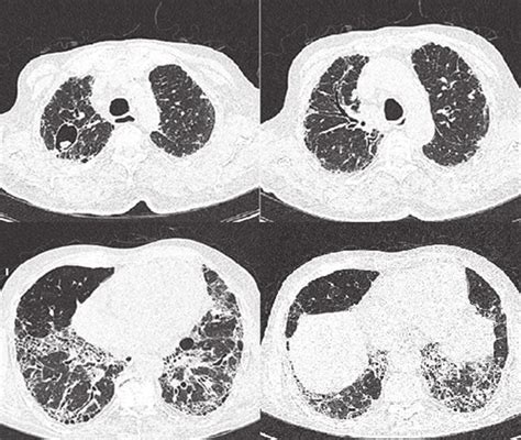High Resolution Computerized Tomography Sections Of The Patient Hrct