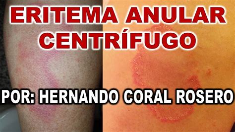 Eritema Anular CentrÍfugo Youtube