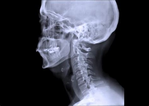 Esophagus Vs Windpipe What Is The Difference Swent