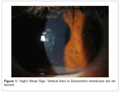 The Genetics Of Keratoconus A Review