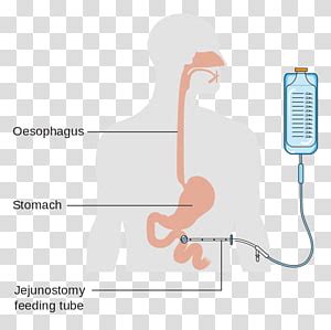 Feeding Tube Gastrostomy Enteral Nutrition Jejunostomy Kangaroo