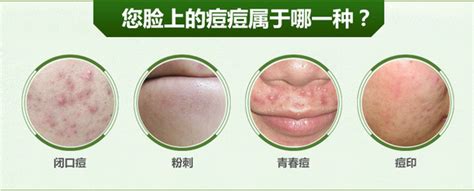 长痘不是你想的那样简单 知乎