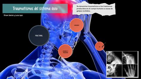 Traumatismos Del Sistema óseo By Miriam Sanchez Magdaleno On Prezi