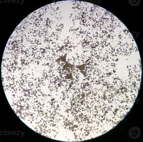 Microscopic Image Of Urinalysis Abnormal Urine Exam Uric Acid
