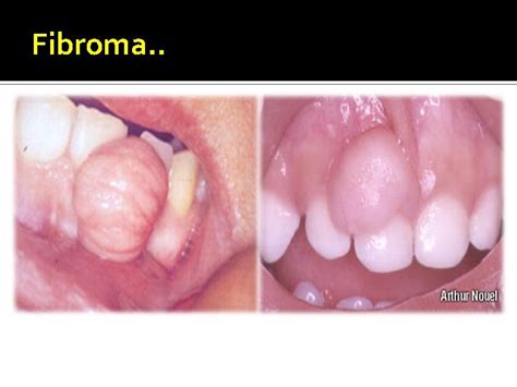 Benign And Malignant Connective Tissue Tumours Fibroma Most
